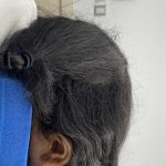 Plastic Surgery Case Study - The Two Stage Large Skull Implant ...