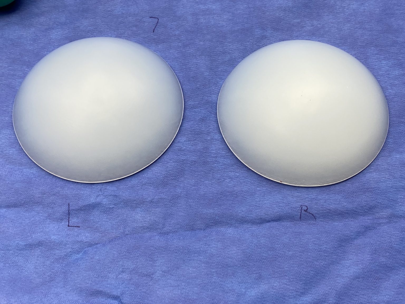 Plastic Surgery Case Study - Male Buttock Augmentation with 400cc ...