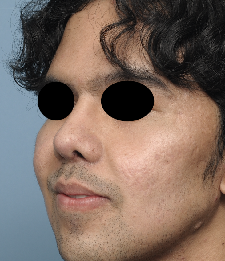 Plastic Surgery Case Study - An Improved Infraorbital-Malar Implant ...