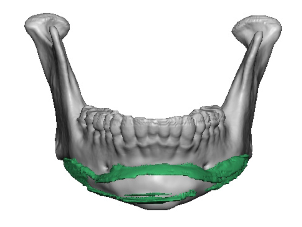 3D Assessment of Chin Implant Imprinting and Bone Overgrowth - Explore ...