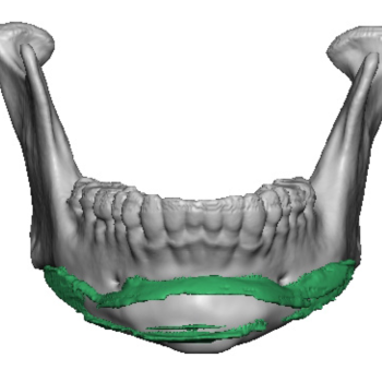 facial implants Archives - Explore Plastic Surgery
