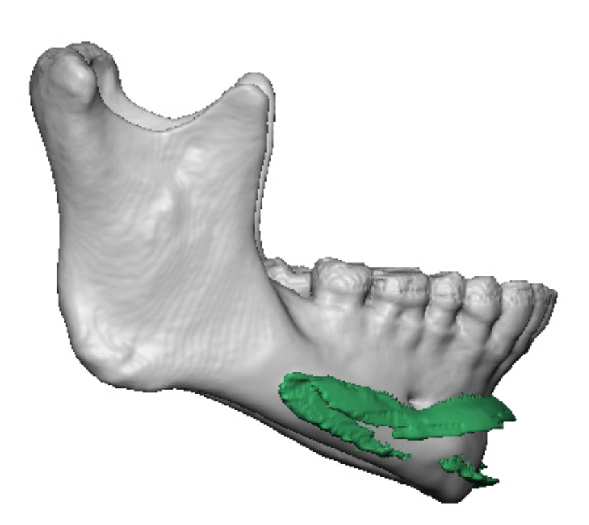3D Assessment of Chin Implant Imprinting and Bone Overgrowth - Explore ...