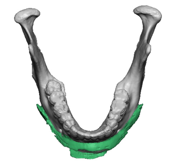3D Assessment of Chin Implant Imprinting and Bone Overgrowth - Explore ...