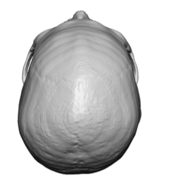 Plastic Surgery Case Study - Custom Skull Implant for the Male Crown of ...