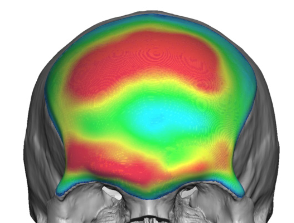 Can A Brow Bone Implant Create A Brow Lowering Effect? - Explore ...