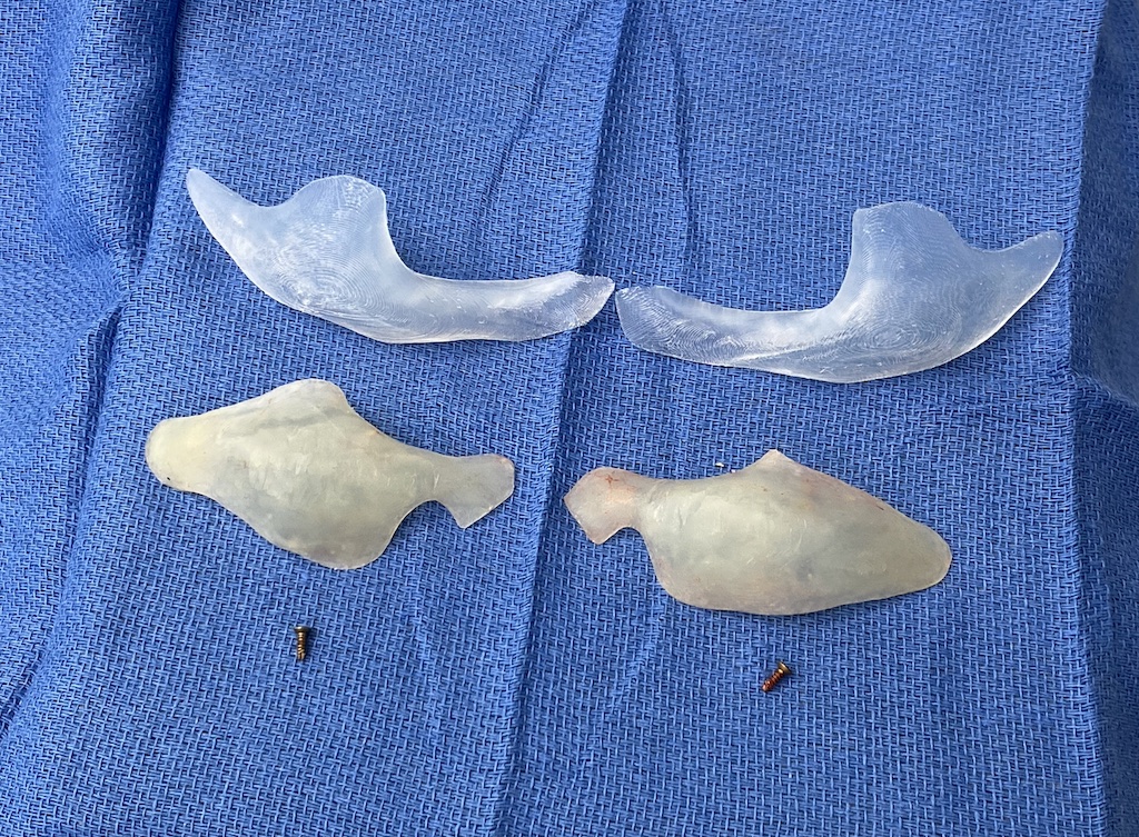 Plastic Surgery Case Study - An Improved Infraorbital-Malar Implant ...