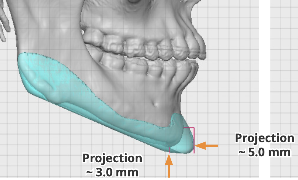 Plastic Surgery Case Study - Aesthetic Designing of the Male Custom ...