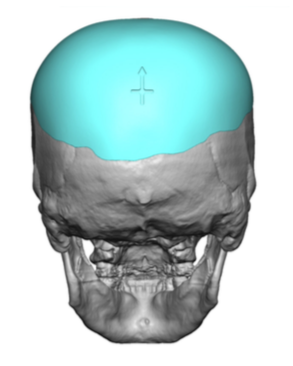 Plastic Surgery Case Study - Custom Skull Implant for the Male Crown of ...