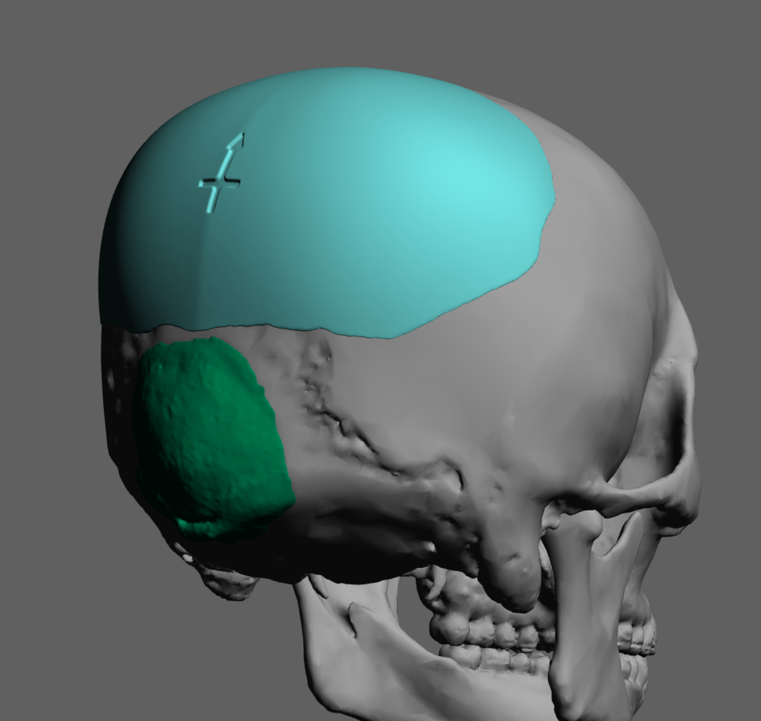 Plastic Surgery Case Study - Dual Back of The Head Reshaping with ...