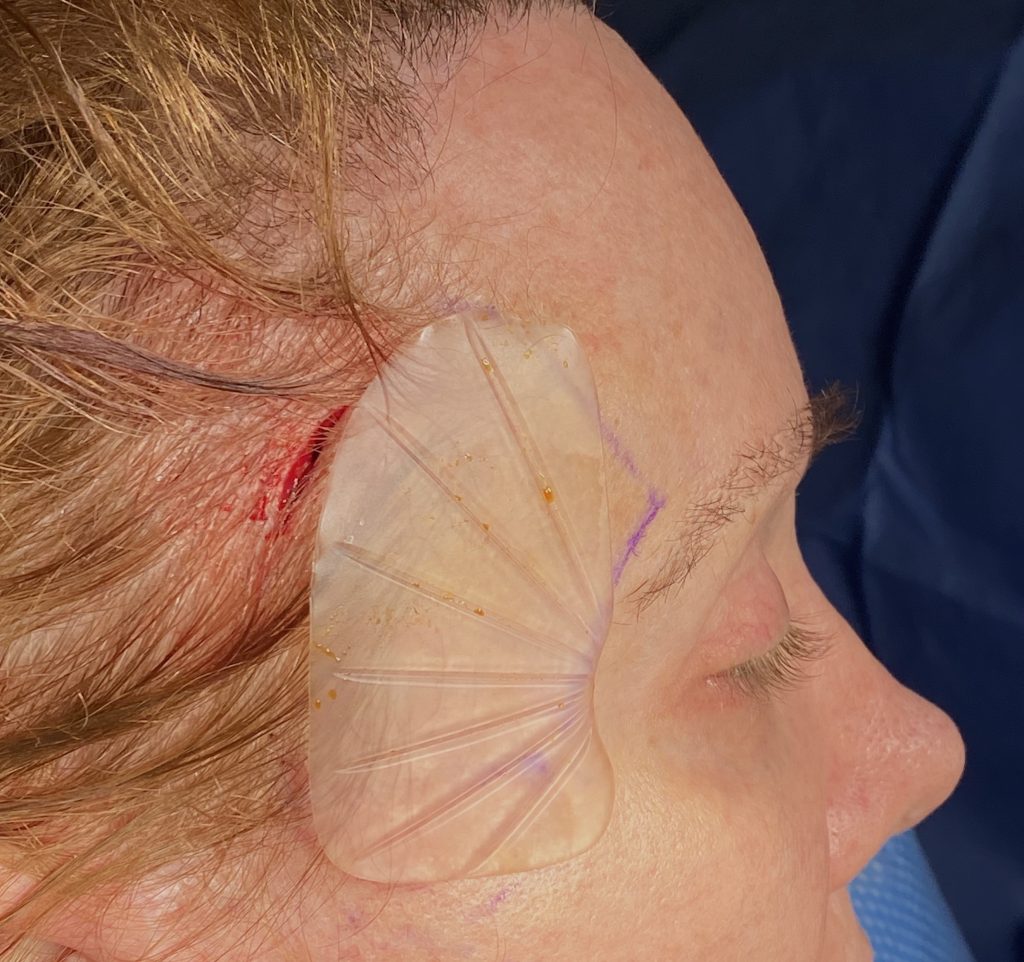 Plastic Surgery Case Study - Temporal and Lateral Facial Implants for ...