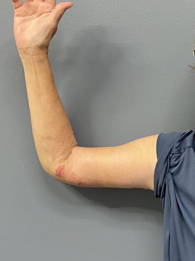 Plastic Surgery Case Study - The Fasciocutaneous Flap Method For Major ...