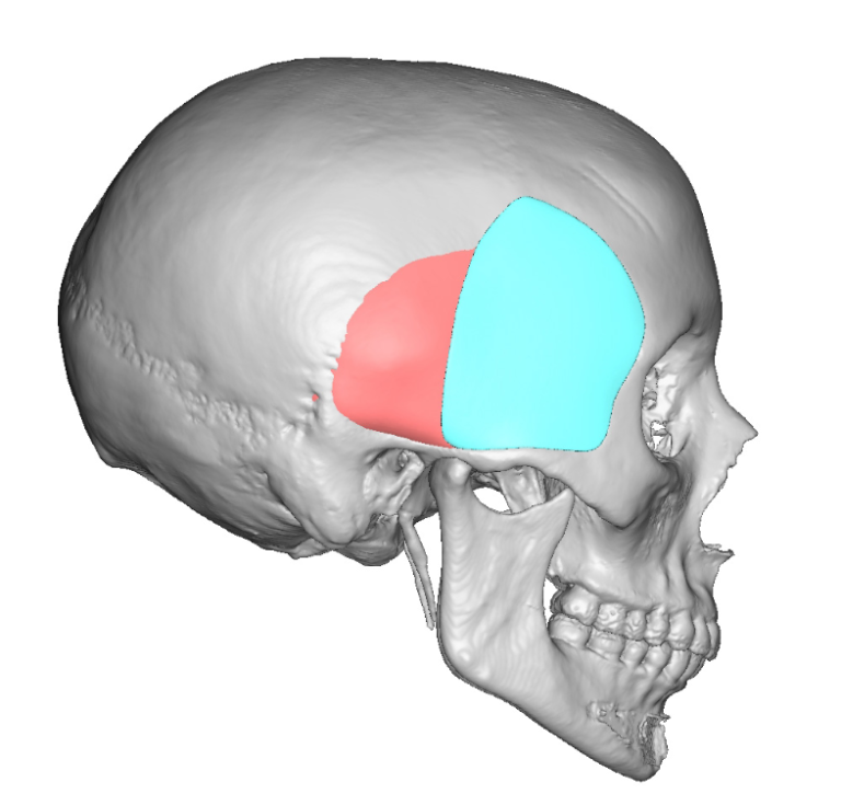 Plastic Surgery Case Study - Custom Temporal Implants for Asymmetric ...