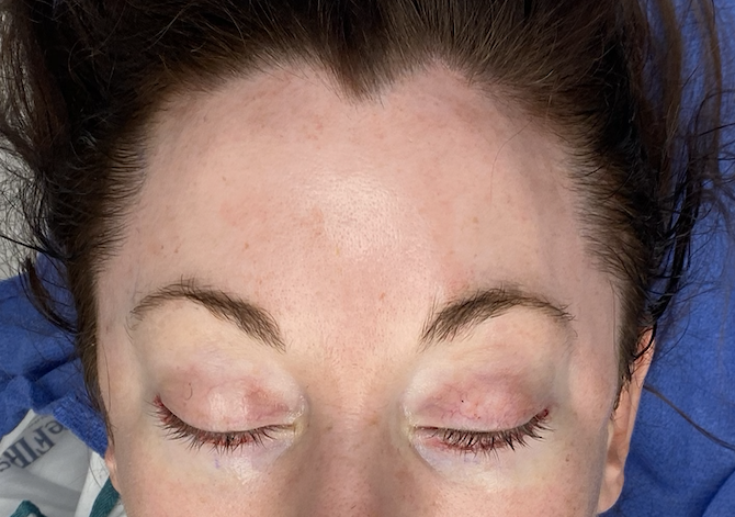 Plastic Surgery Case Study - Custom Temporal Implants for Asymmetric ...