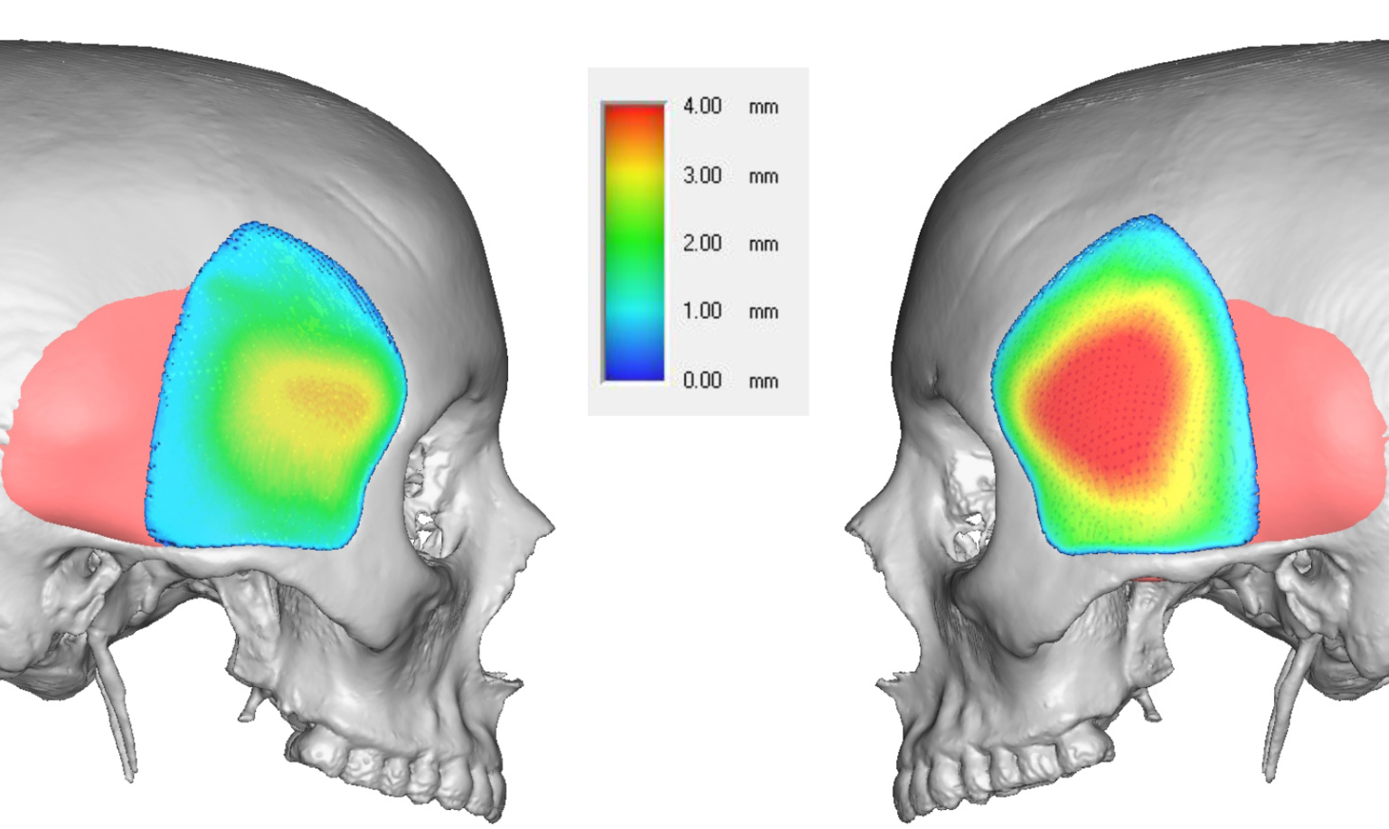 Plastic Surgery Case Study - Custom Temporal Implants for Asymmetric ...
