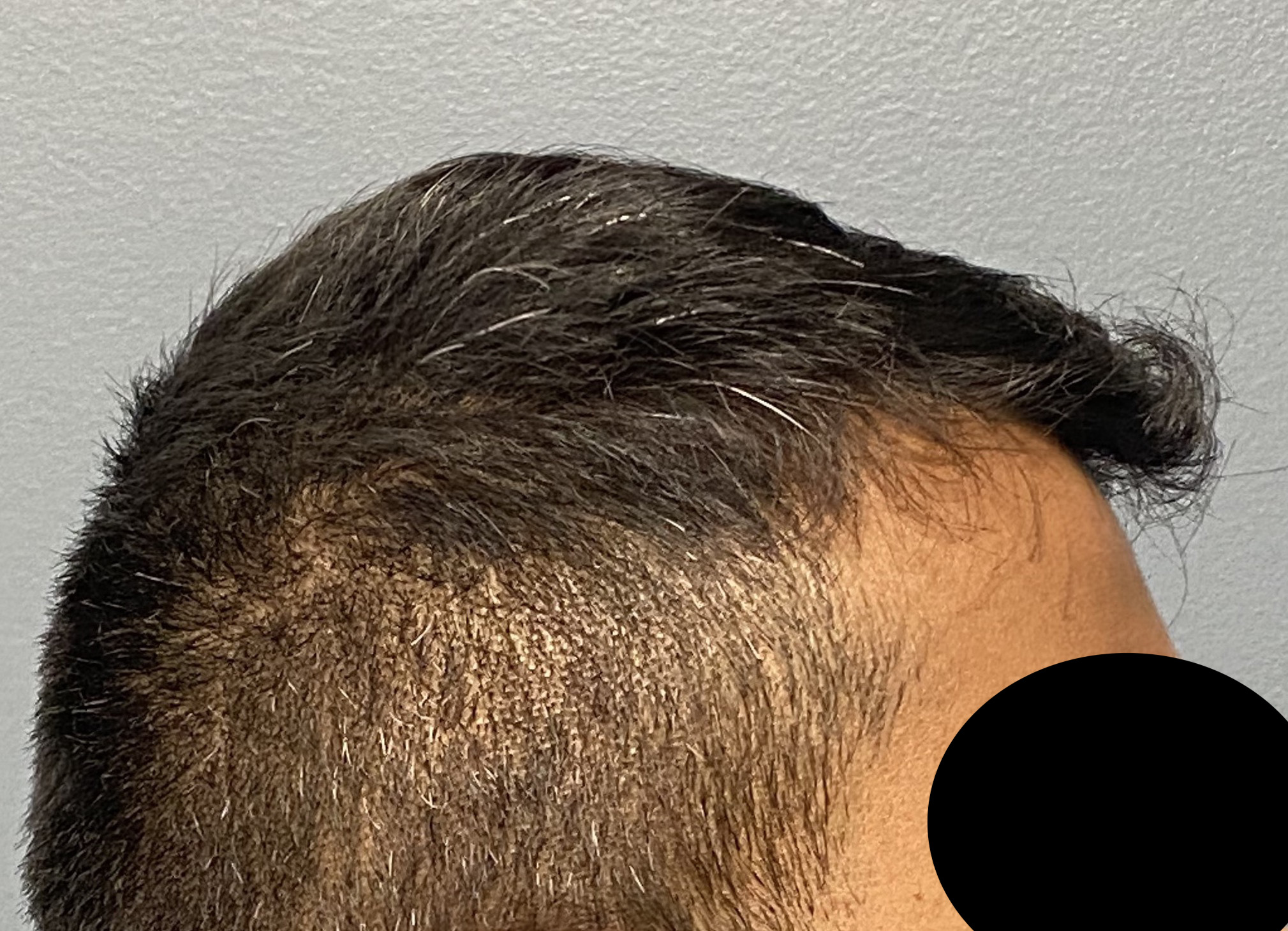 Plastic Surgery Case Study - Top of the Head Skull Reduction For ...