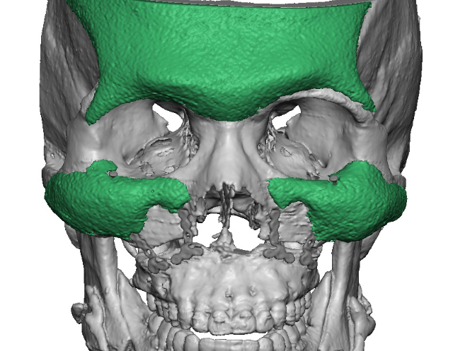 Plastic Surgery Case Study - An Improved Infraorbital-Malar Implant ...