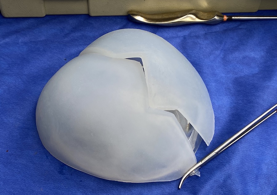 Plastic Surgery Case Study - The Two Stage Large Skull Implant ...