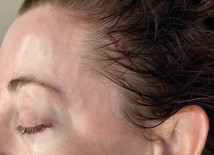 Plastic Surgery Case Study - Custom Temporal Implants for Asymmetric ...