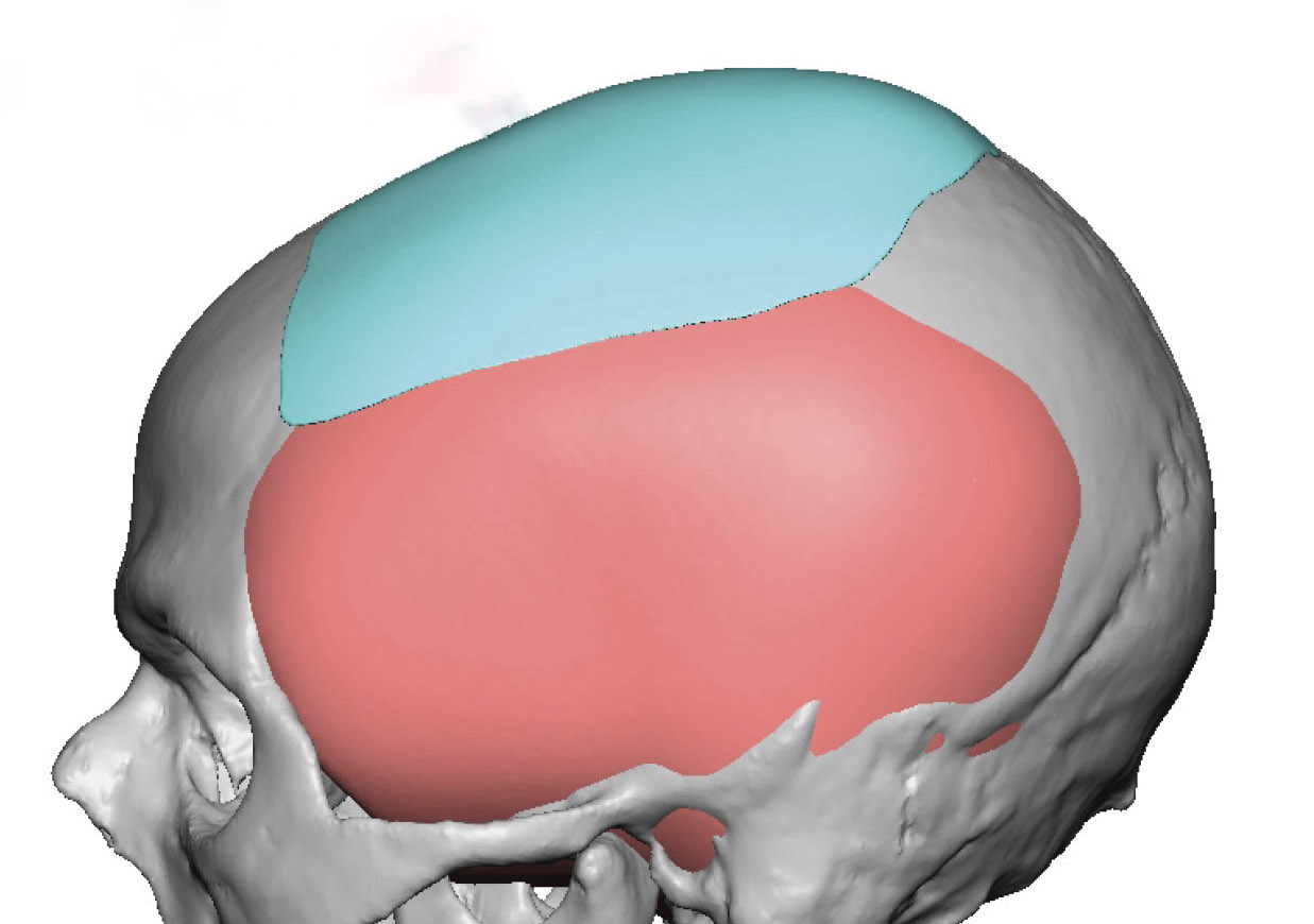Plastic Surgery Case Study - Custom Skull Implant for a Left ...