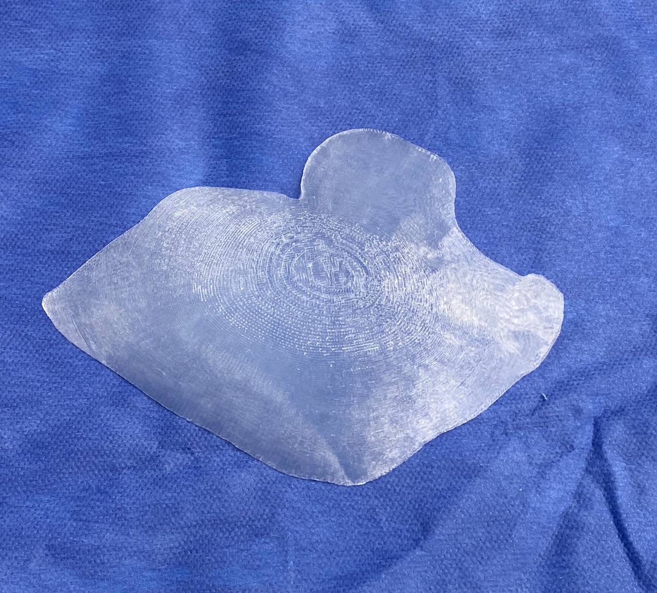 Plastic Surgery Case Study - Custom Skull Implant for a Left ...