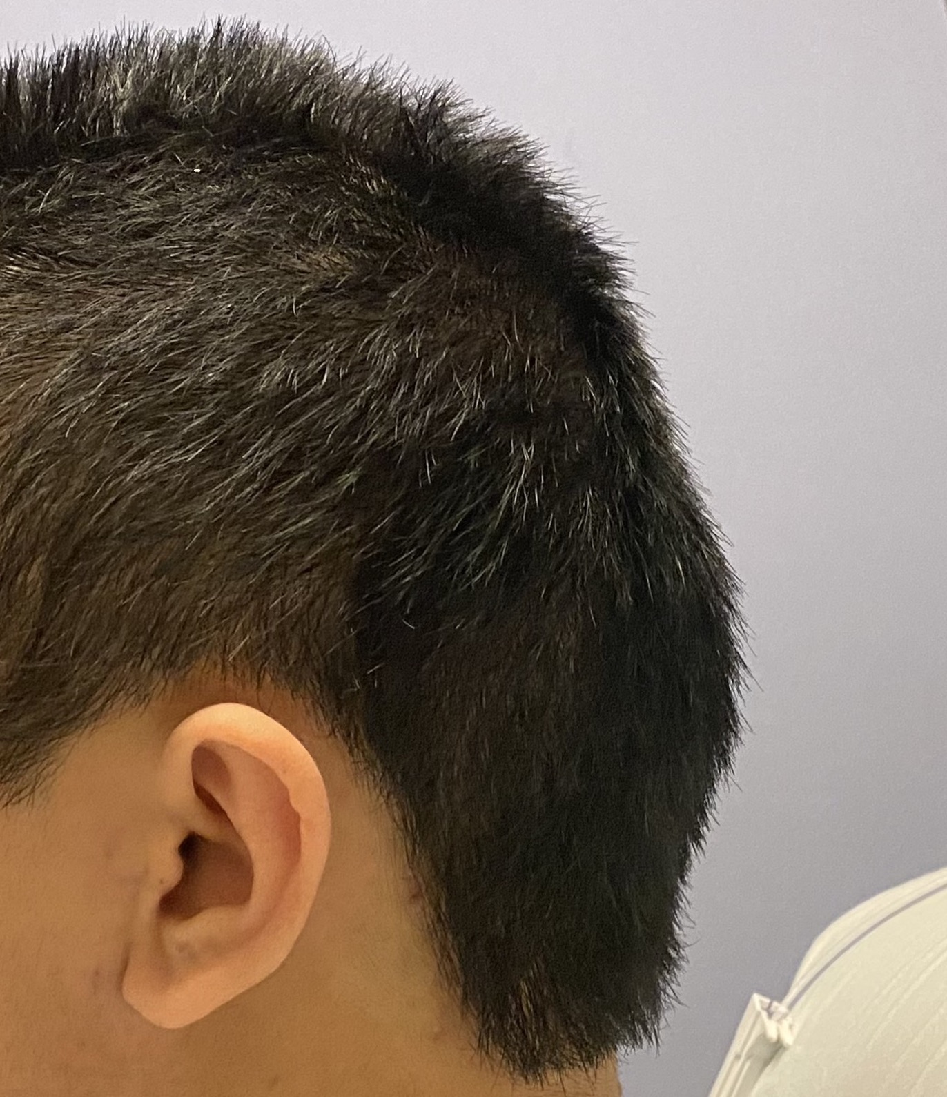 Plastic Surgery Case Study - Dual Back of The Head Reshaping with ...