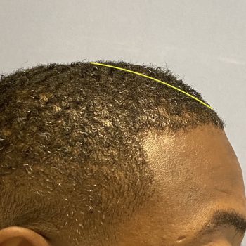 skull reshaping Archives - Explore Plastic Surgery