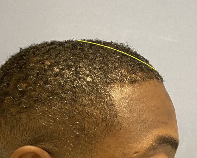 Plastic Surgery Case Study - Reduction Of The Anterior Fontanelle Skull ...