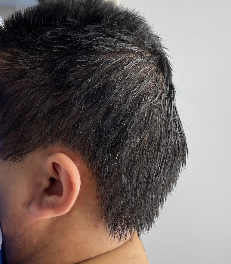 Plastic Surgery Case Study - Dual Back of The Head Reshaping with ...