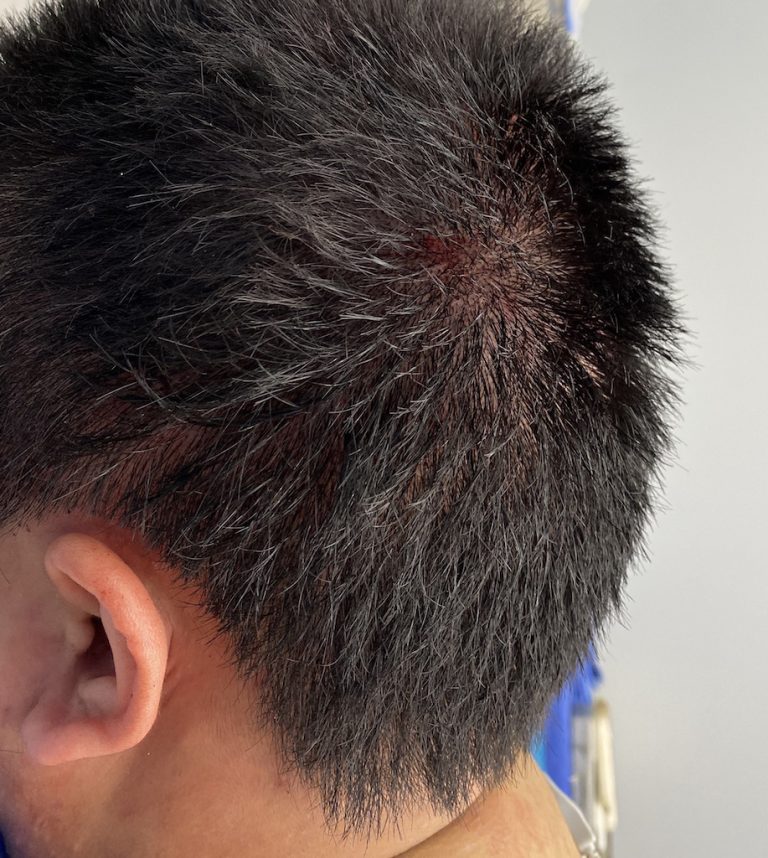 Plastic Surgery Case Study - Dual Back of The Head Reshaping with ...