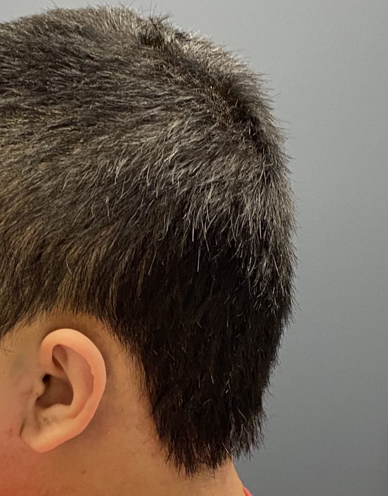 Plastic Surgery Case Study - Dual Back of The Head Reshaping with ...