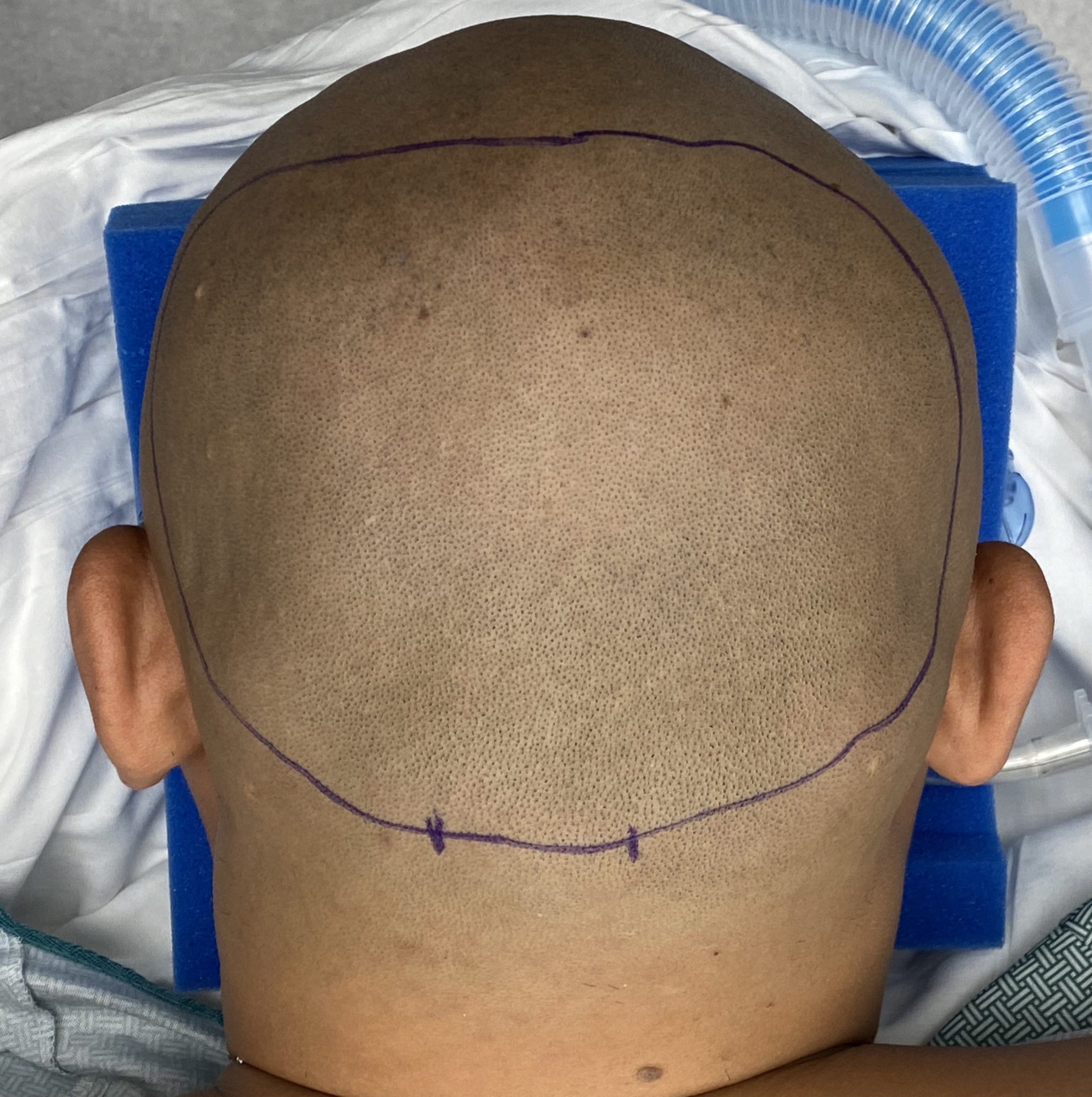 Plastic Surgery Case Study - Lengthening The Brachycephalic Head Shape ...
