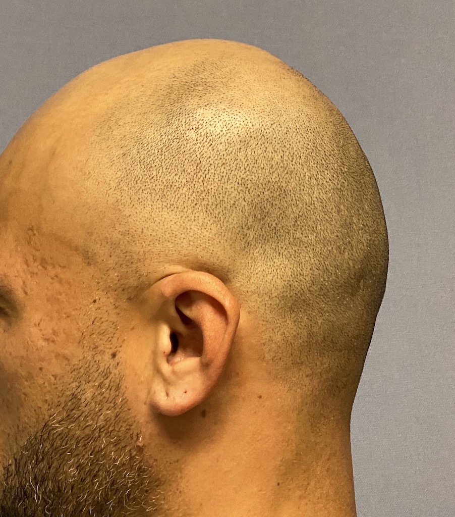 Plastic Surgery Case Study - Custom Skull Implant for the Male Crown of ...