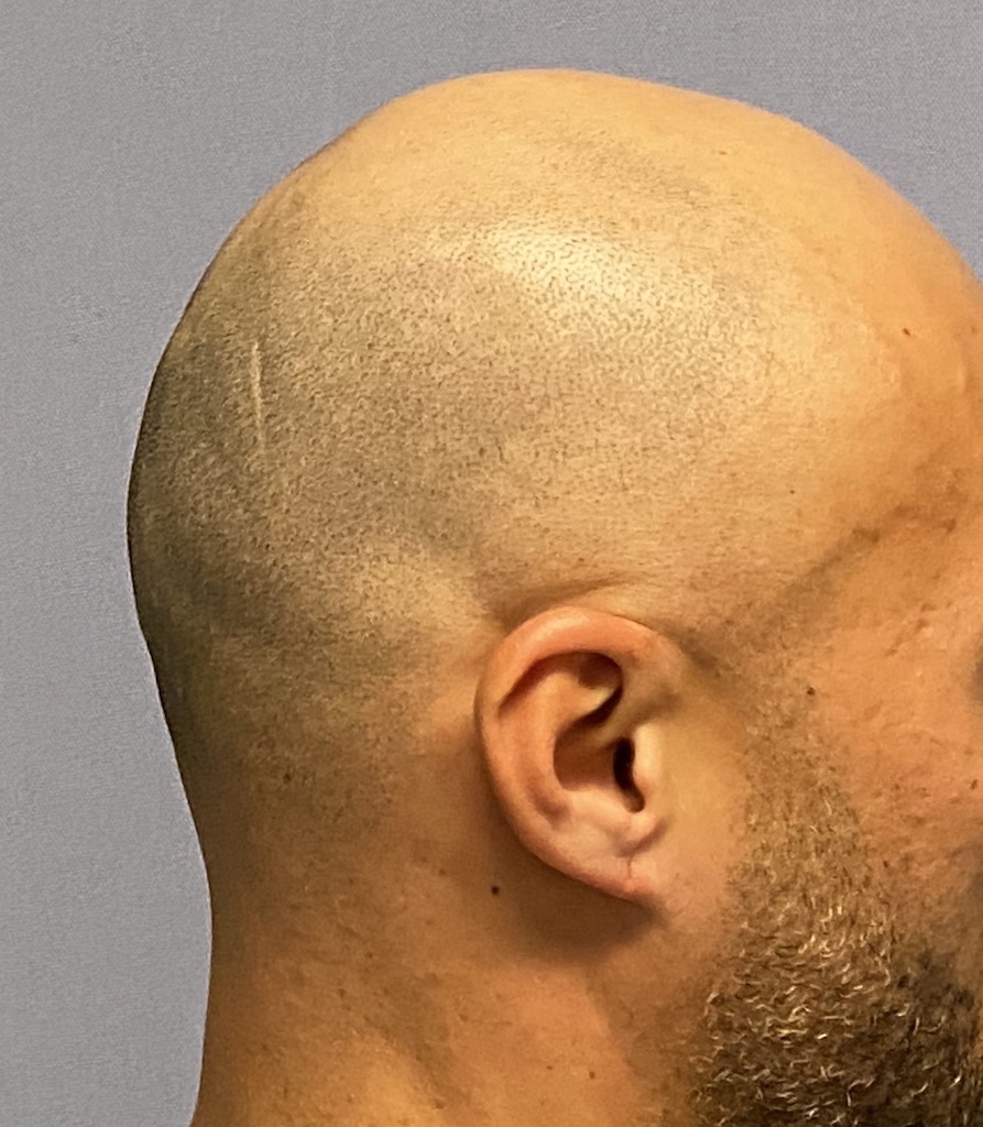 Plastic Surgery Case Study - Custom Skull Implant for the Male Crown of ...