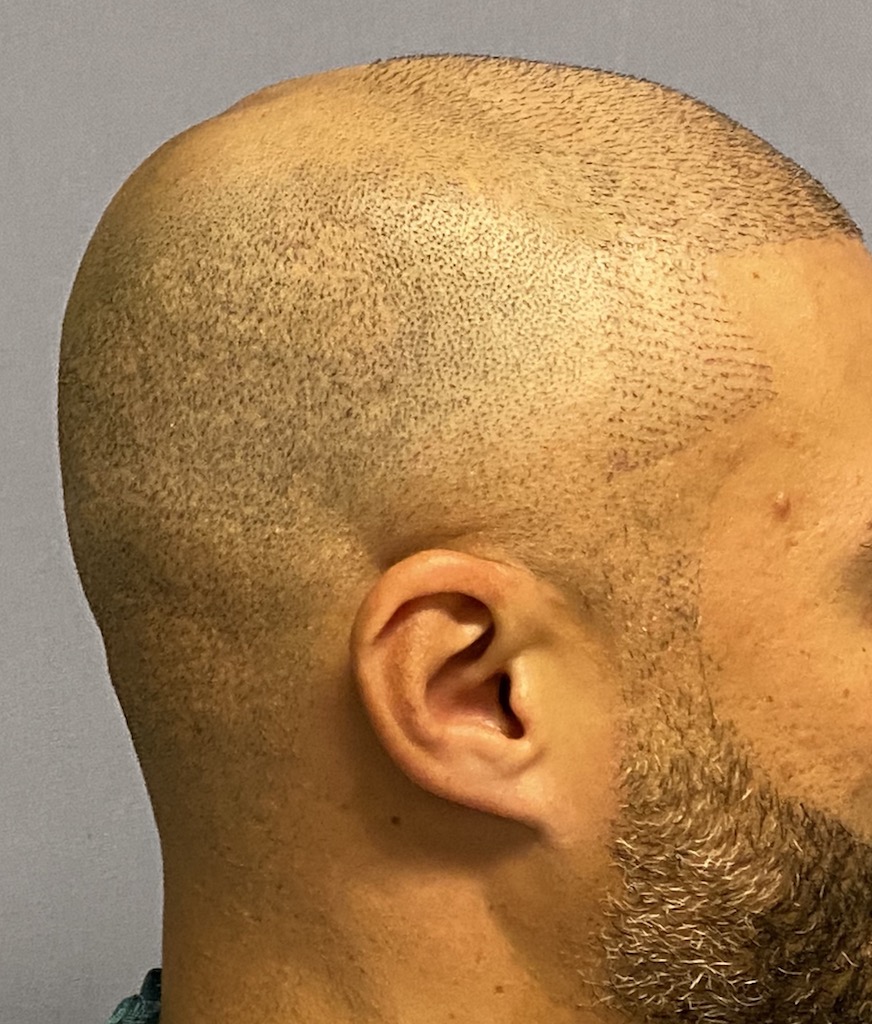 Plastic Surgery Case Study - Custom Skull Implant for the Male Crown of ...