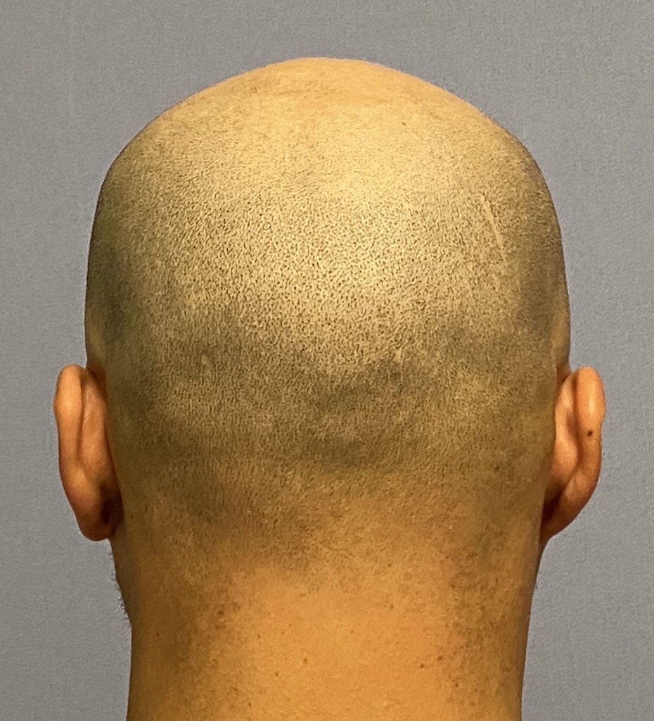 Plastic Surgery Case Study - Custom Skull Implant for the Male Crown of ...