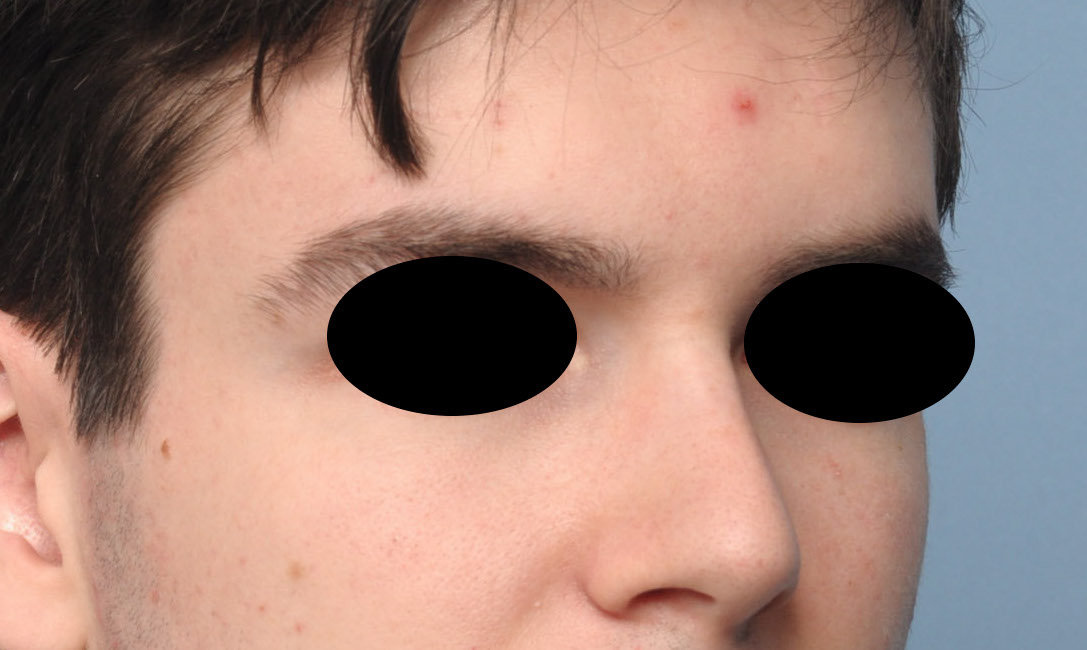 Plastic Surgery Case Study - Custom Infraorbital-Malar Implants for the ...