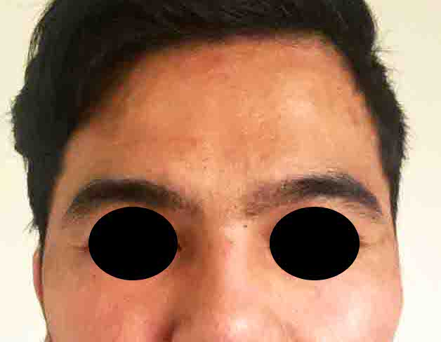 Can A Brow Bone Implant Create A Brow Lowering Effect? - Explore ...