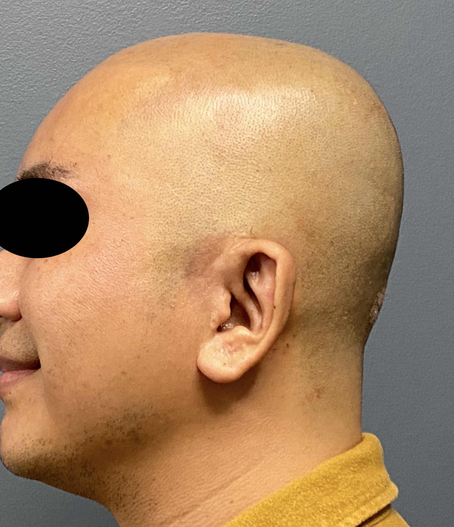 Plastic Surgery Case Study - Lengthening The Brachycephalic Head Shape ...