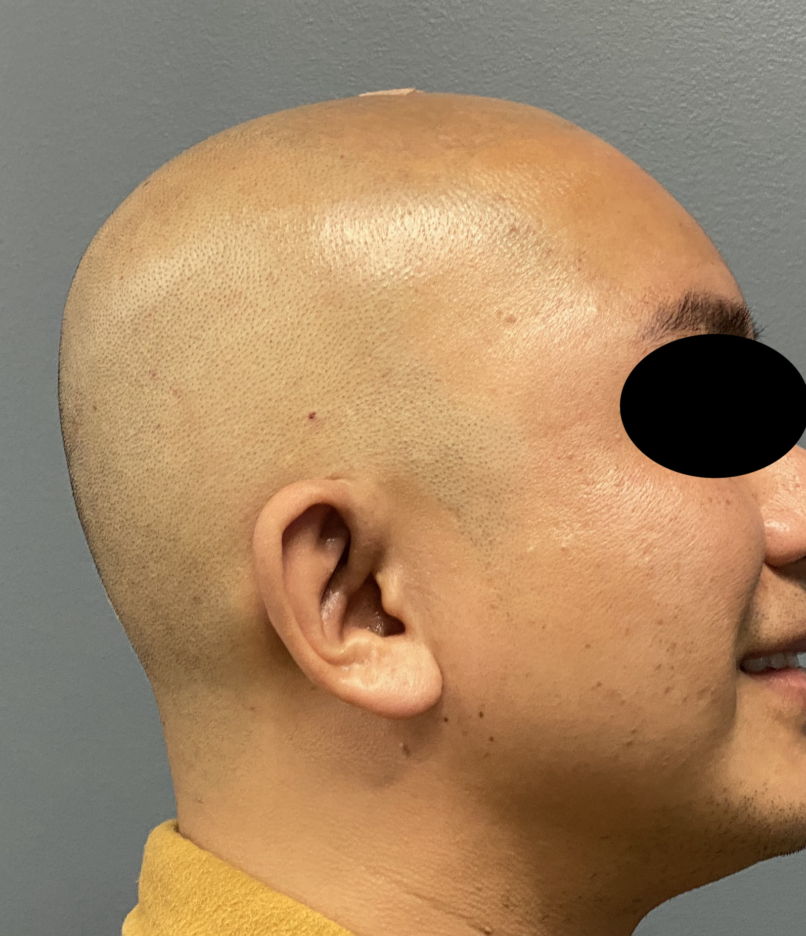 Plastic Surgery Case Study - Lengthening The Brachycephalic Head Shape ...