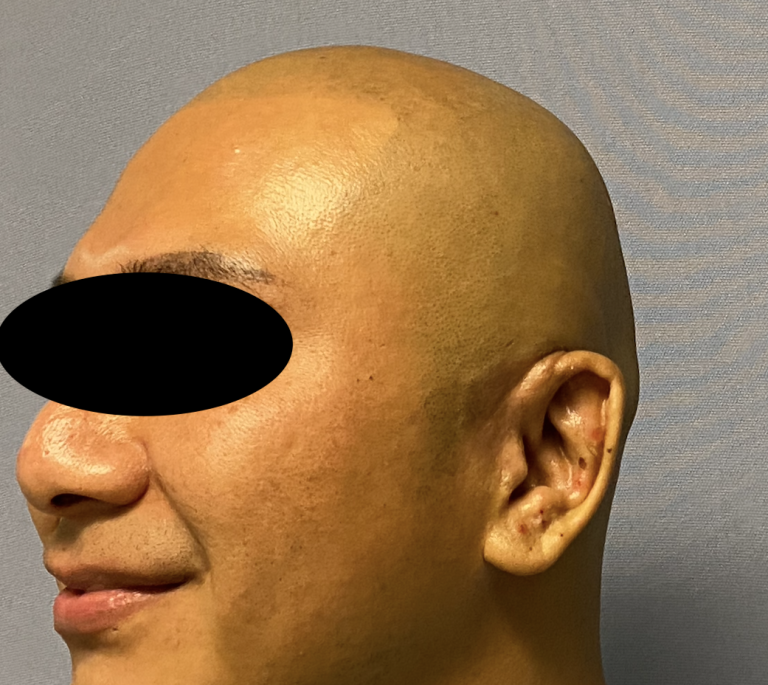 Plastic Surgery Case Study - Lengthening The Brachycephalic Head Shape ...