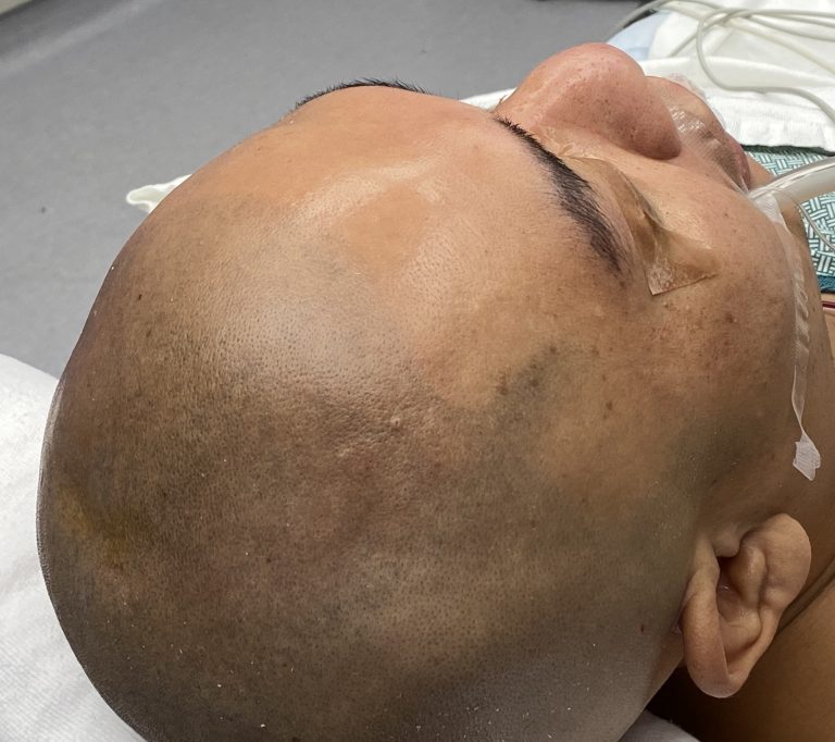 Plastic Surgery Case Study - Lengthening The Brachycephalic Head Shape ...