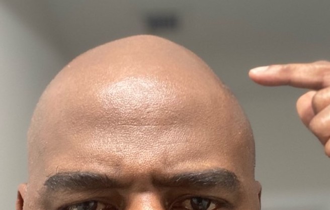 male left parasagittal skull deficiency pointing it out - Explore ...