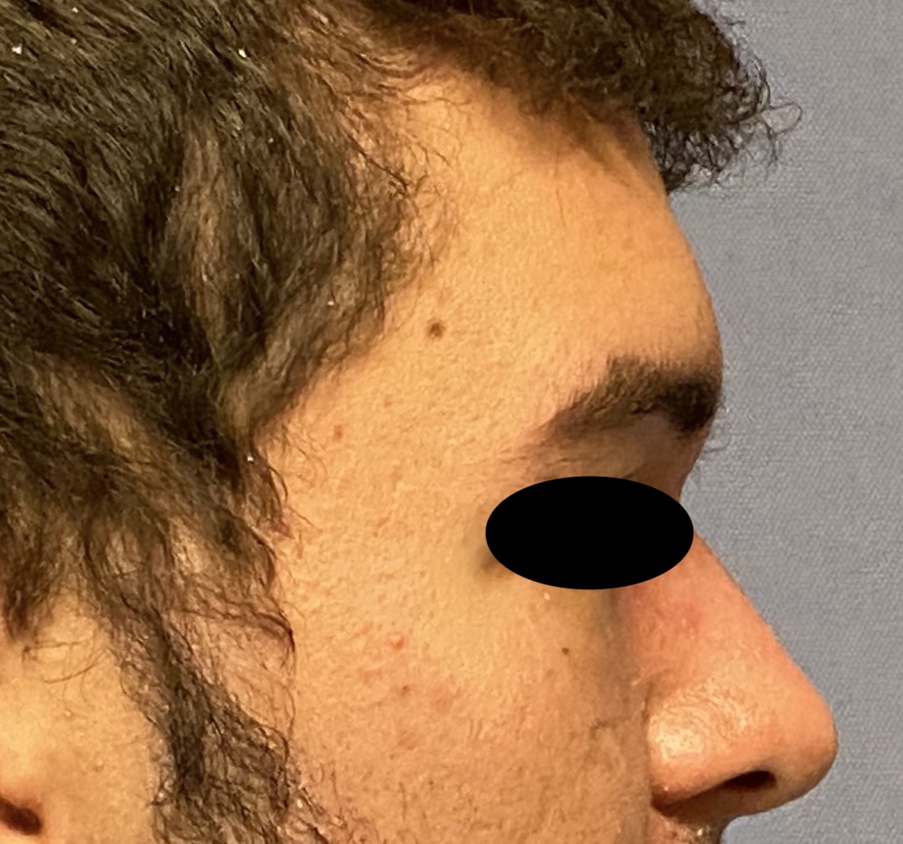 Can A Brow Bone Implant Create A Brow Lowering Effect? - Explore ...