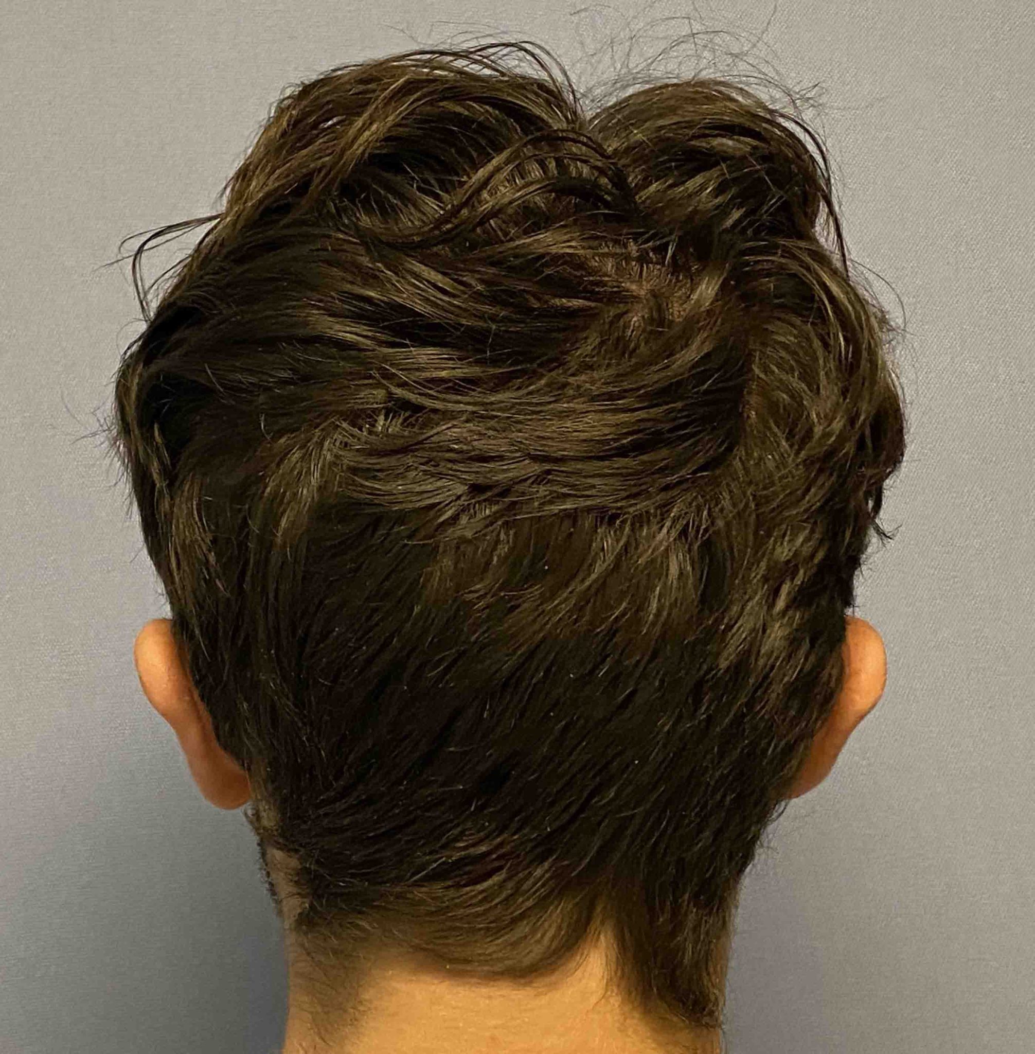 Plastic Surgery Case Study - Posterior Temporal Muscle Removal for Male ...