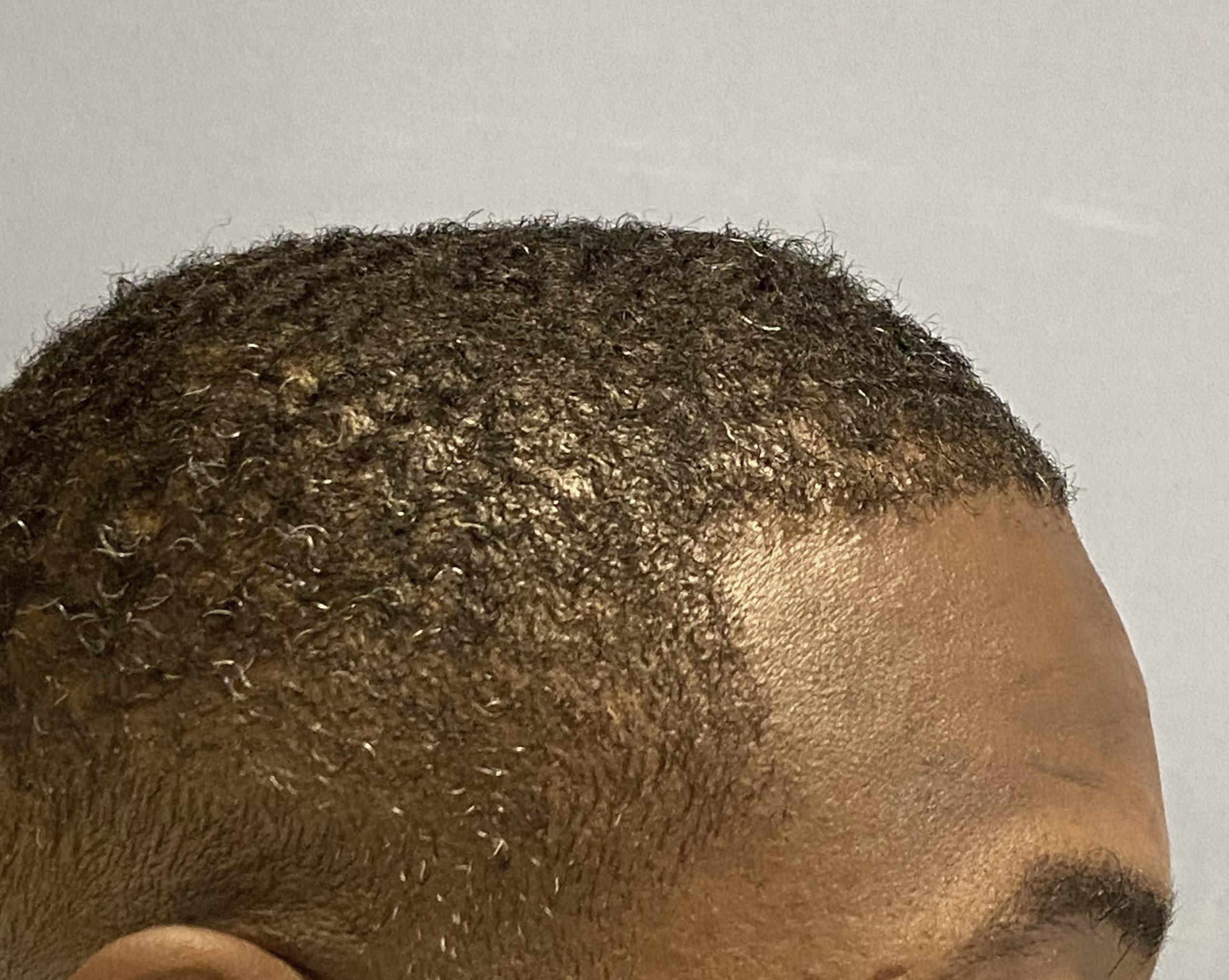 male top of head skull reduction side 1 Dr Barry Eppley - Explore ...