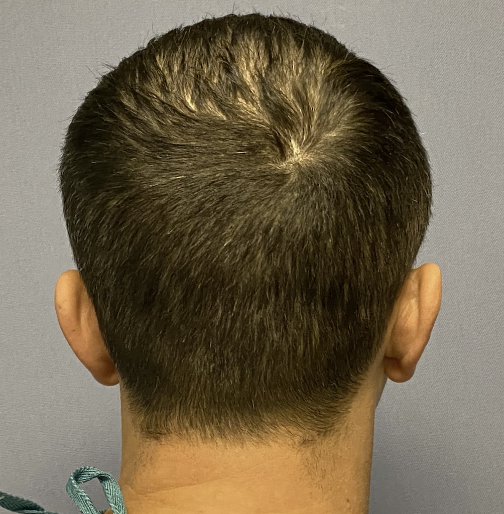 Plastic Surgery Case Study - Male Side of the Head Reductive Reshaping ...