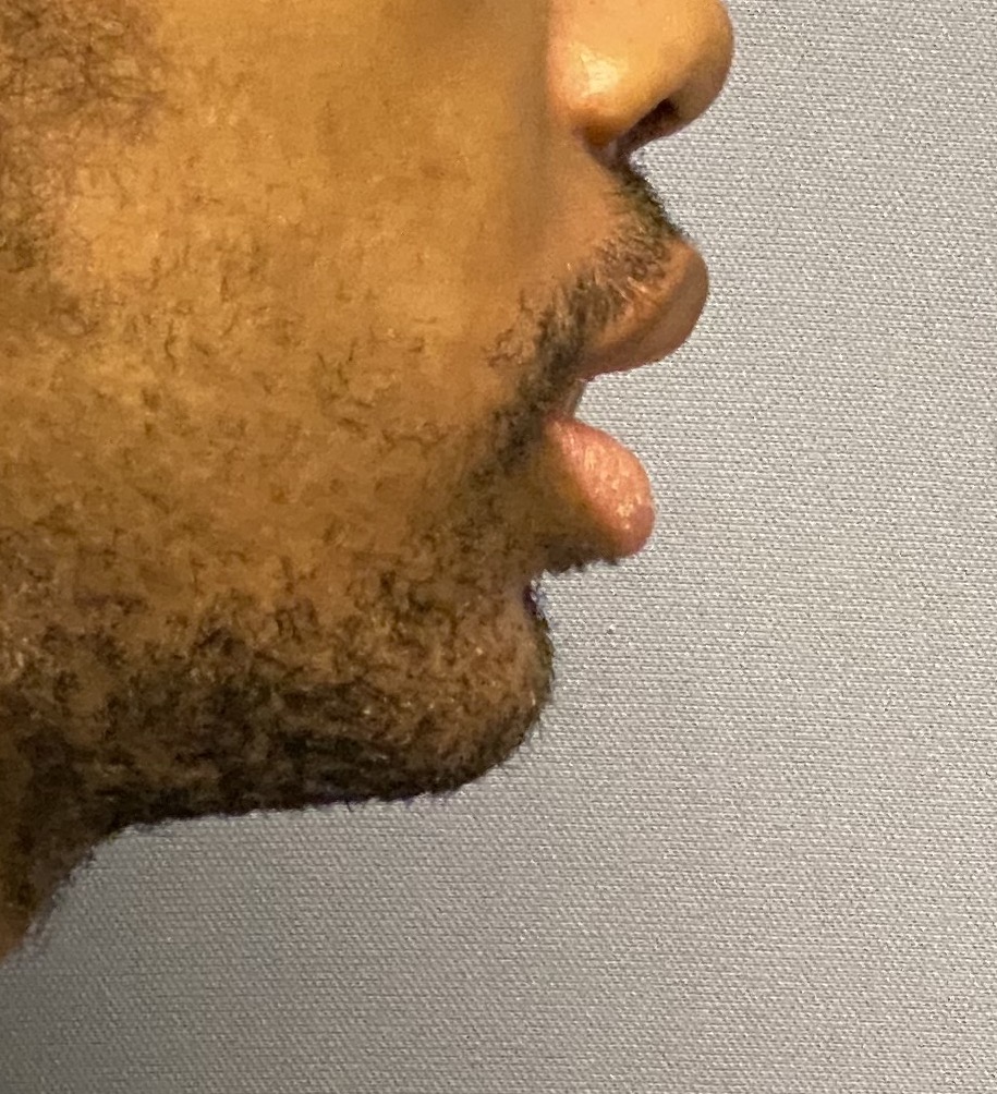 Plastic Surgery Case Study - 16mm Secondary Sliding Genioplasty for ...