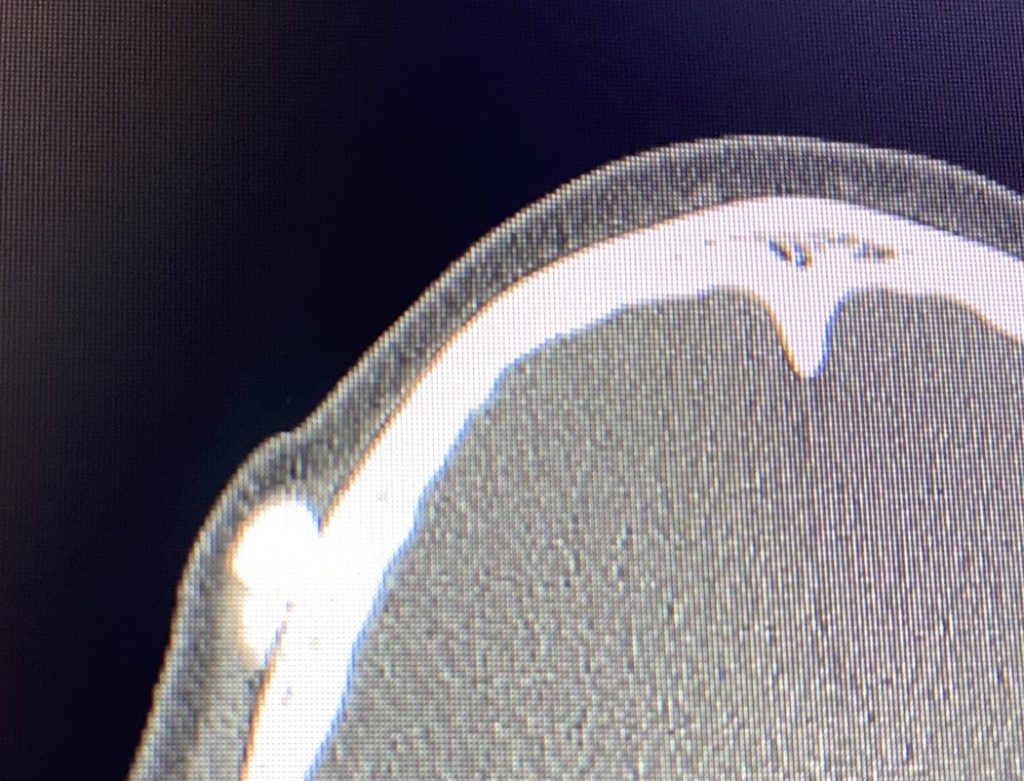 Plastic Surgery Case Study - Removal of Large Right Temporal Osteoma in ...