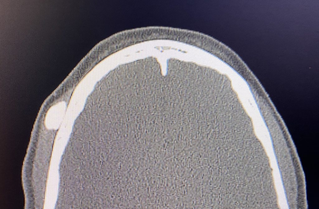 Plastic Surgery Case Study - Removal of Large Right Temporal Osteoma in ...