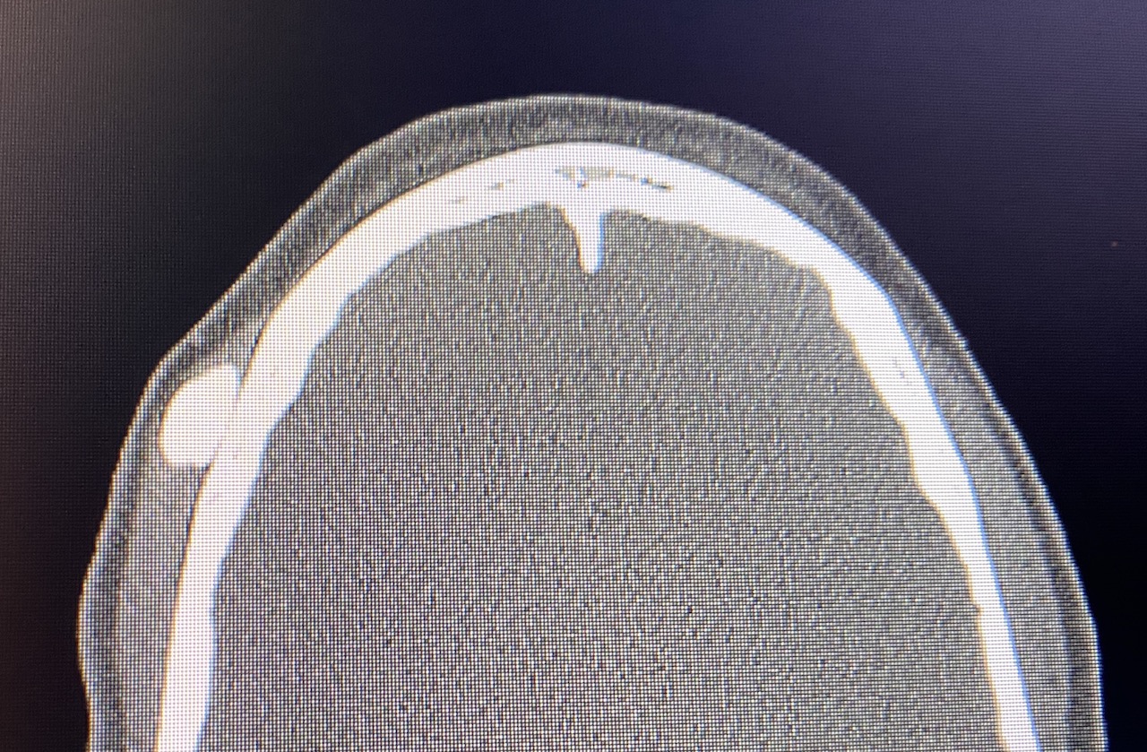 Plastic Surgery Case Study - Removal of Large Right Temporal Osteoma in ...